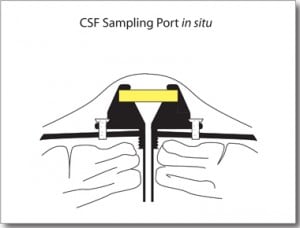 CSF Sampling Port - Phymep